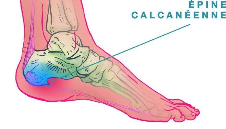 Comment Soigner Une Epine Calcaneenne Naturellement | Chtoby Pomnili